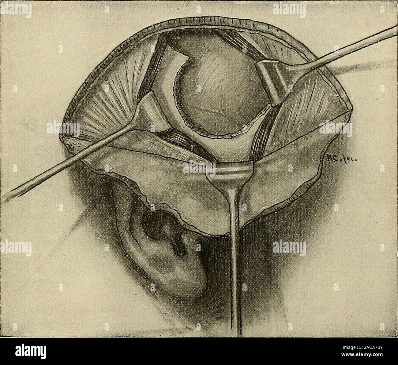 Hernia brain hi-res stock photography and images - Alamy