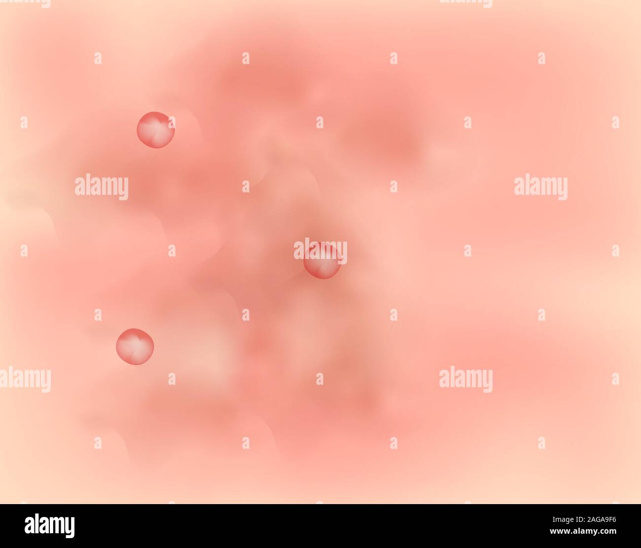 Papules on the skin. Acne. Pimples on the skin background. Acne on the ...