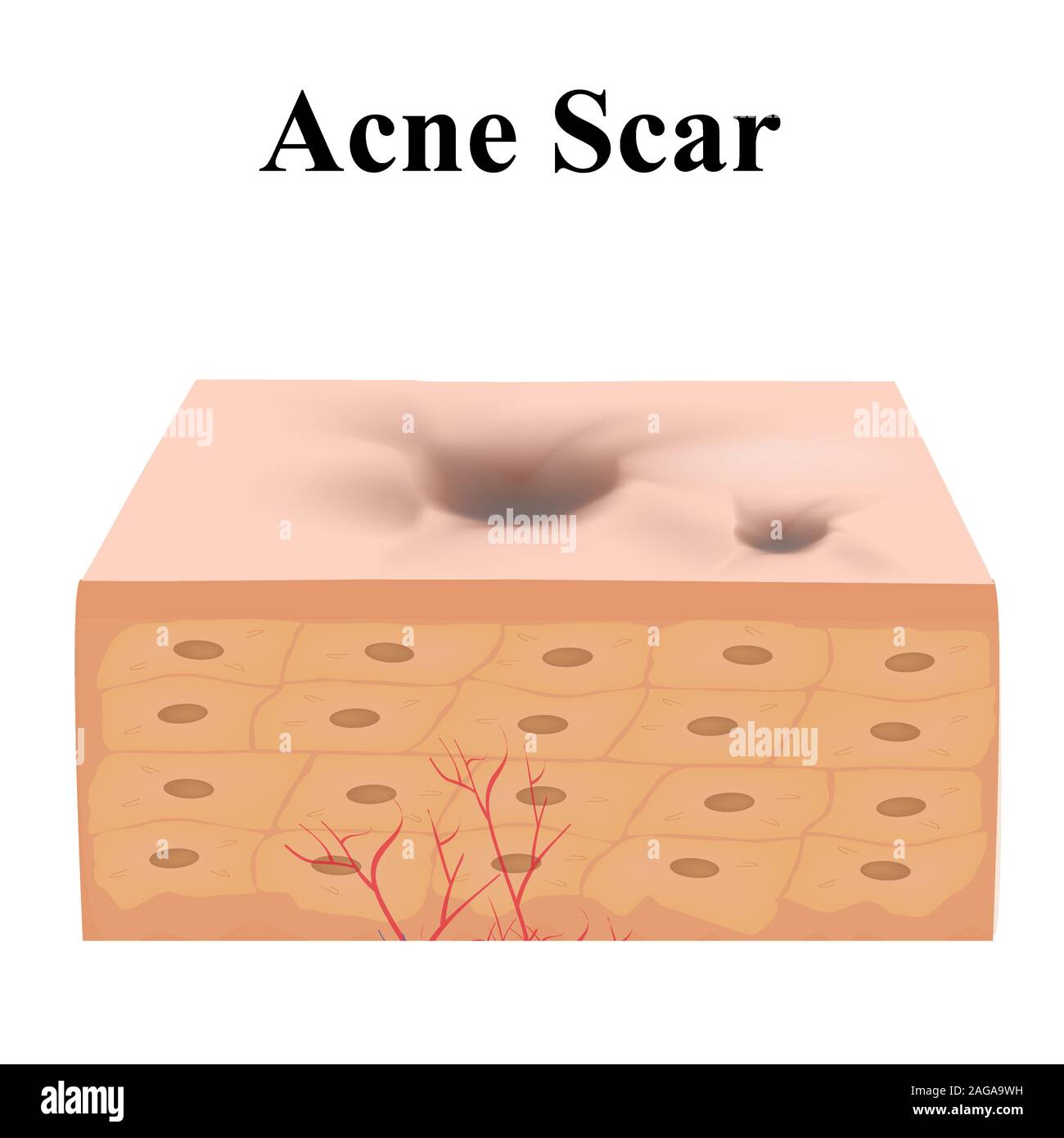 Atrophic scars. Acne scar. The anatomical structure of the skin with ...