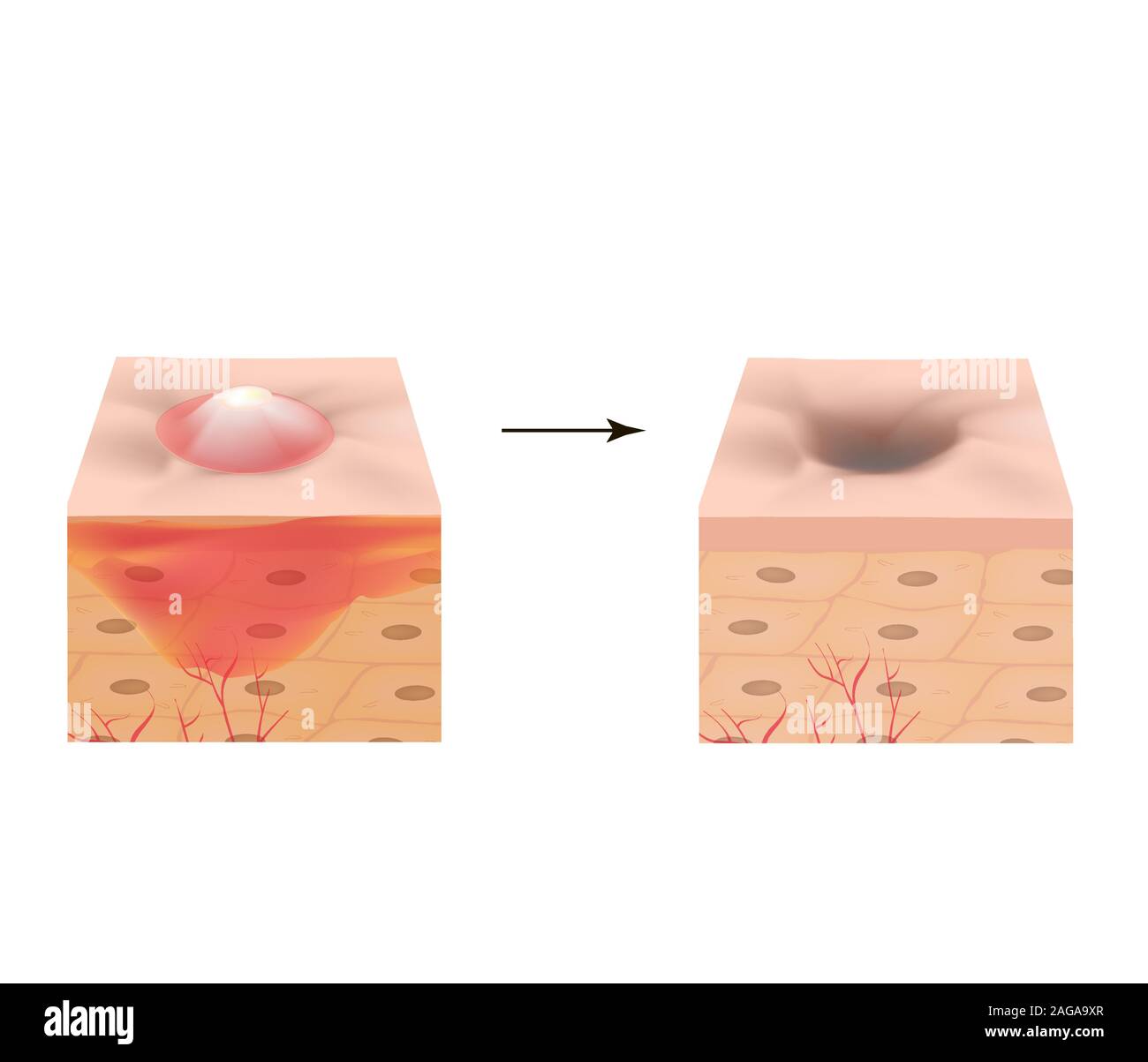 Inflamed acne on the skin. Inflamed pimple. The structure of the skin ...