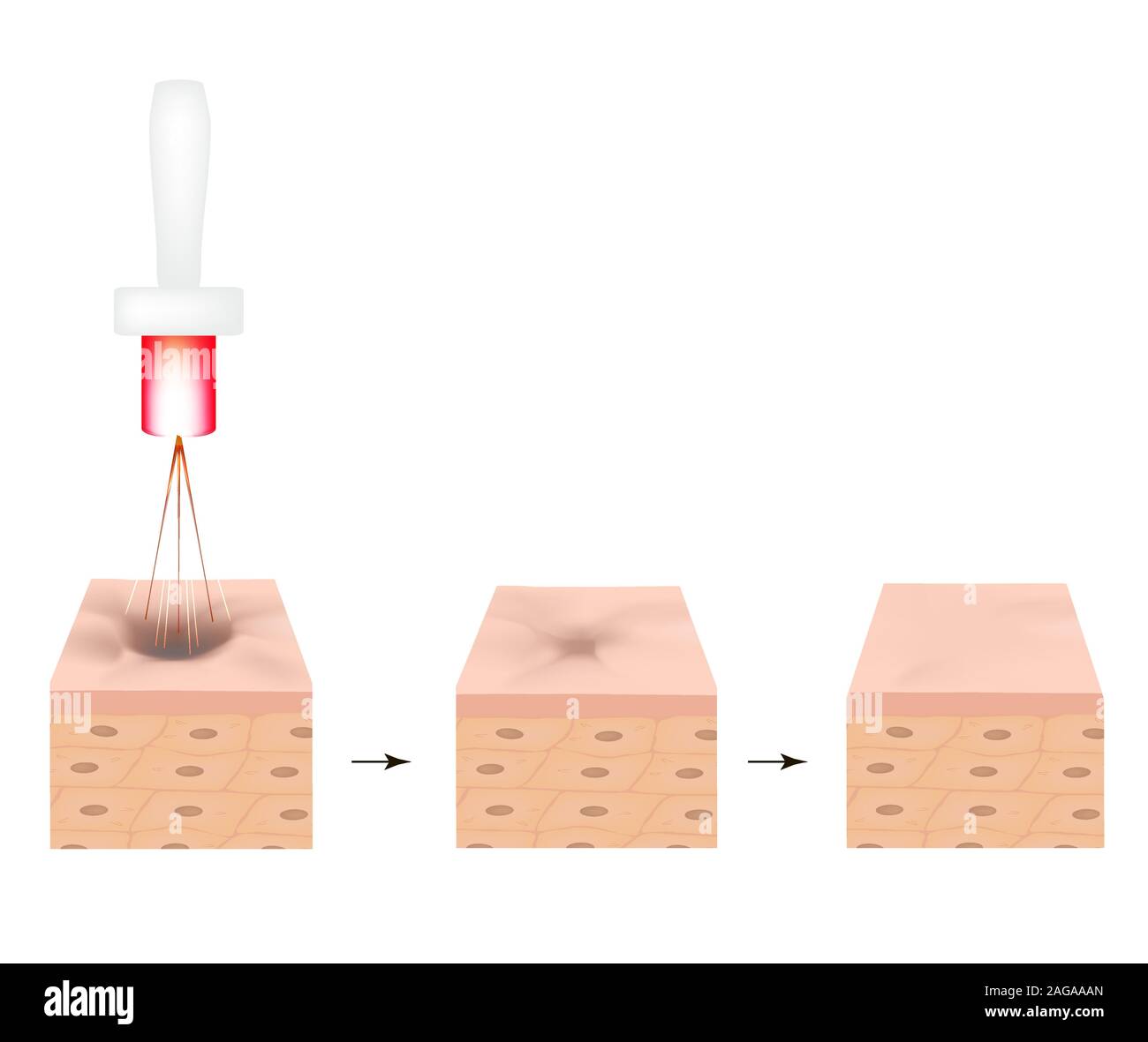 Acne scars. Laser scar atrophic treatment. The anatomical structure of ...
