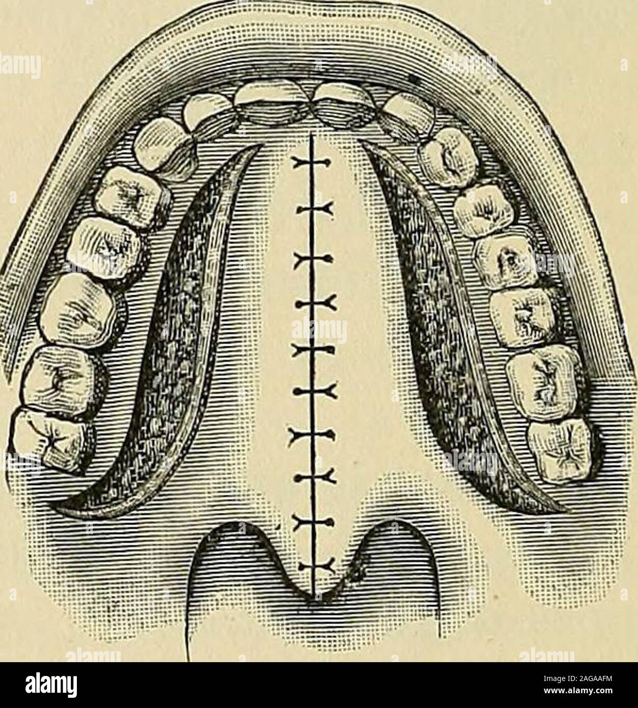 . Operative surgery. Fig. 803.—Curvilinear incision andcleft with ...