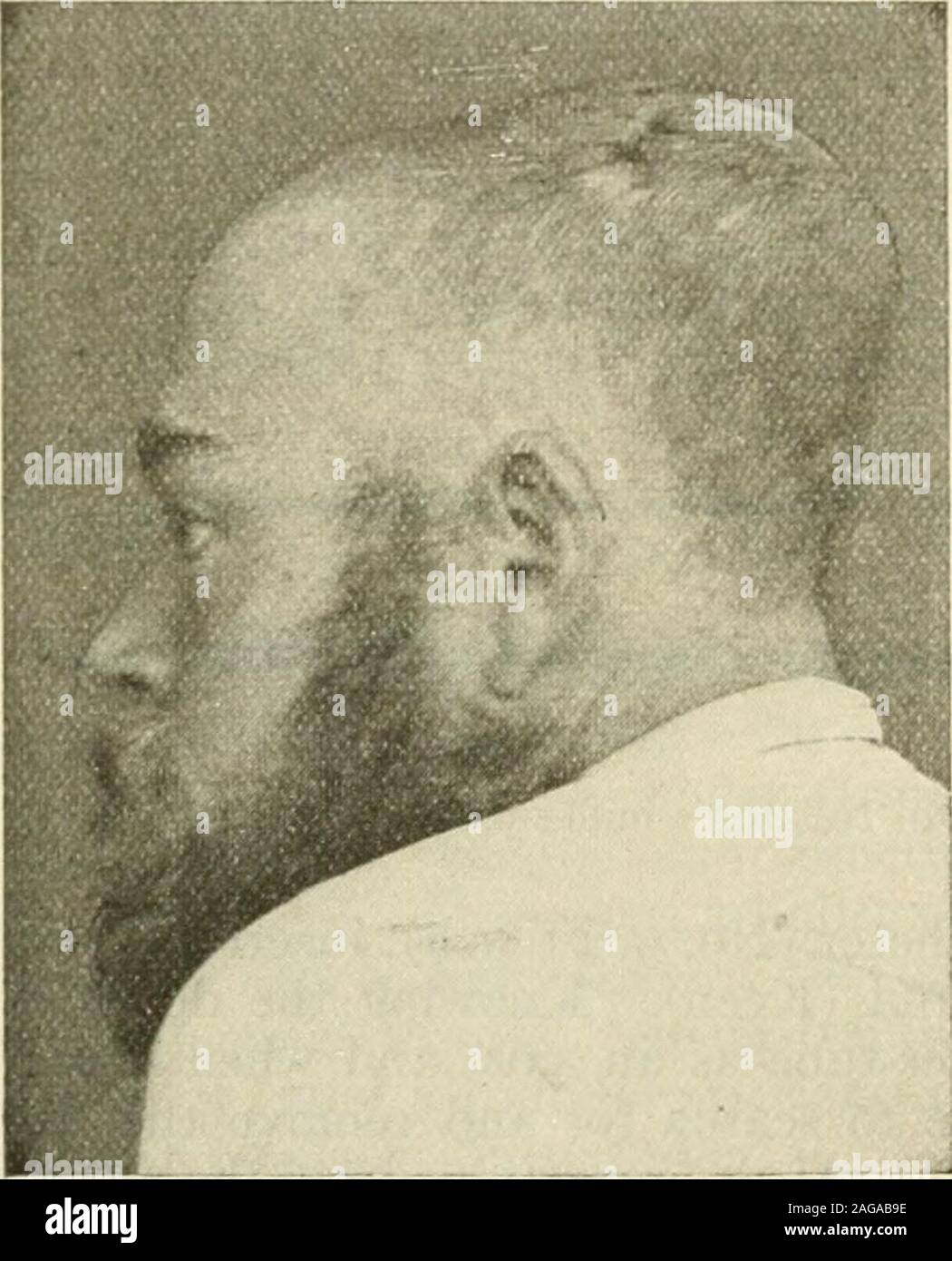 Lumbar punctures hi-res stock photography and images - Alamy