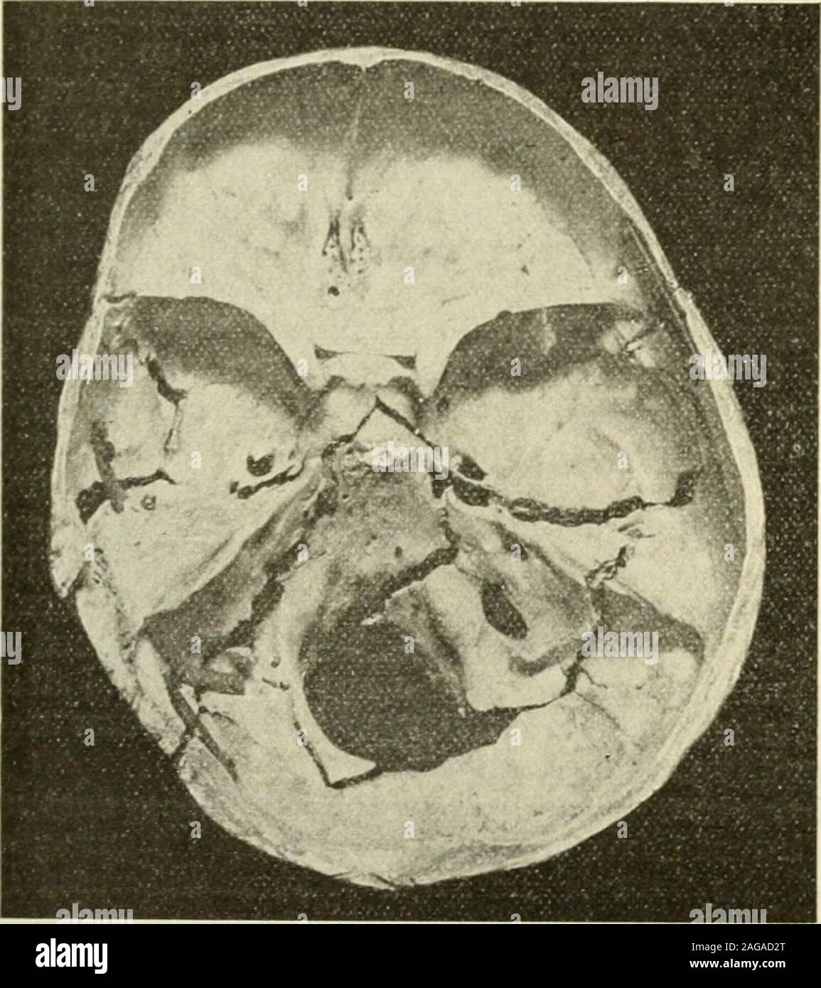 . Modern surgery, general and operative. mmers and to Moores tests,but ...