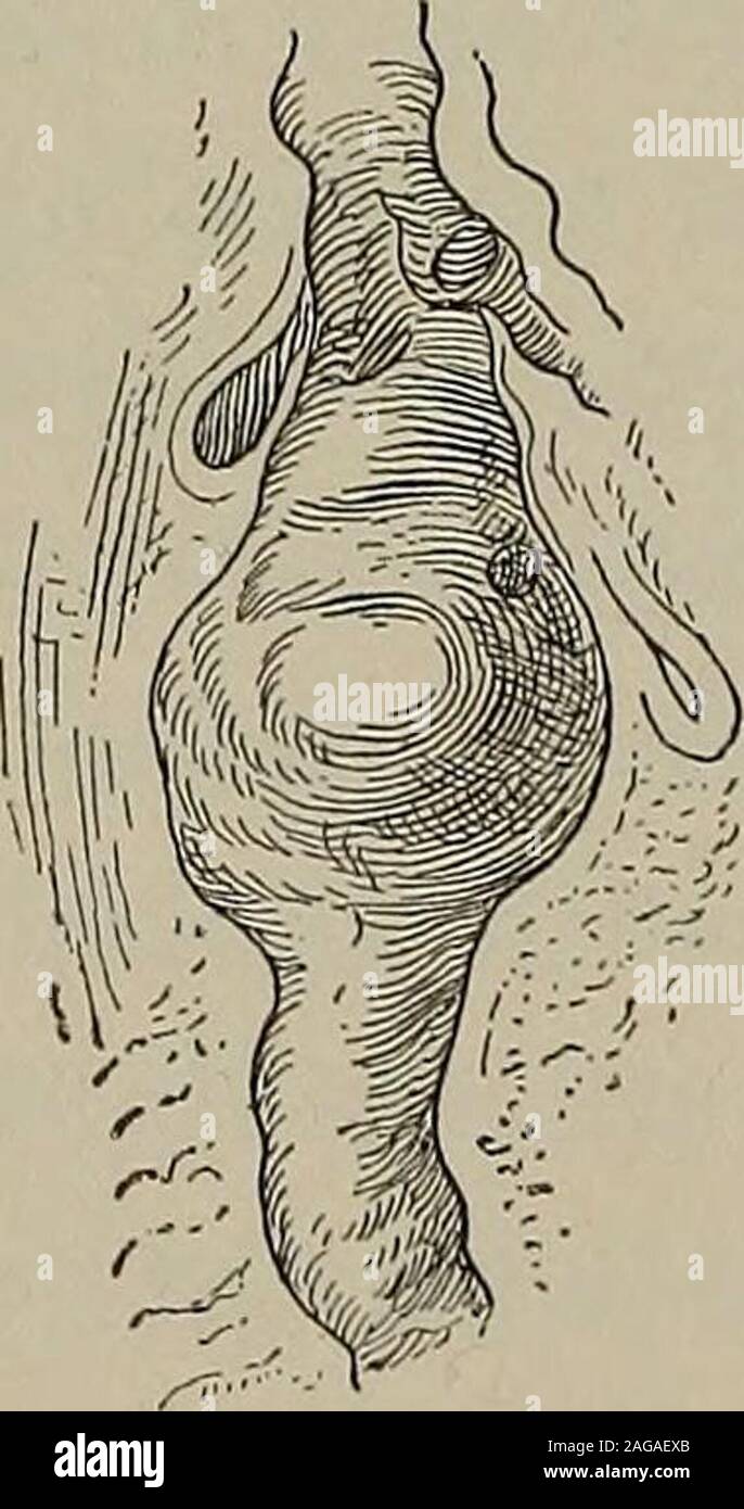 . Diseases of children. Fig. 22.—Large bronchial coagulum; chronic ...