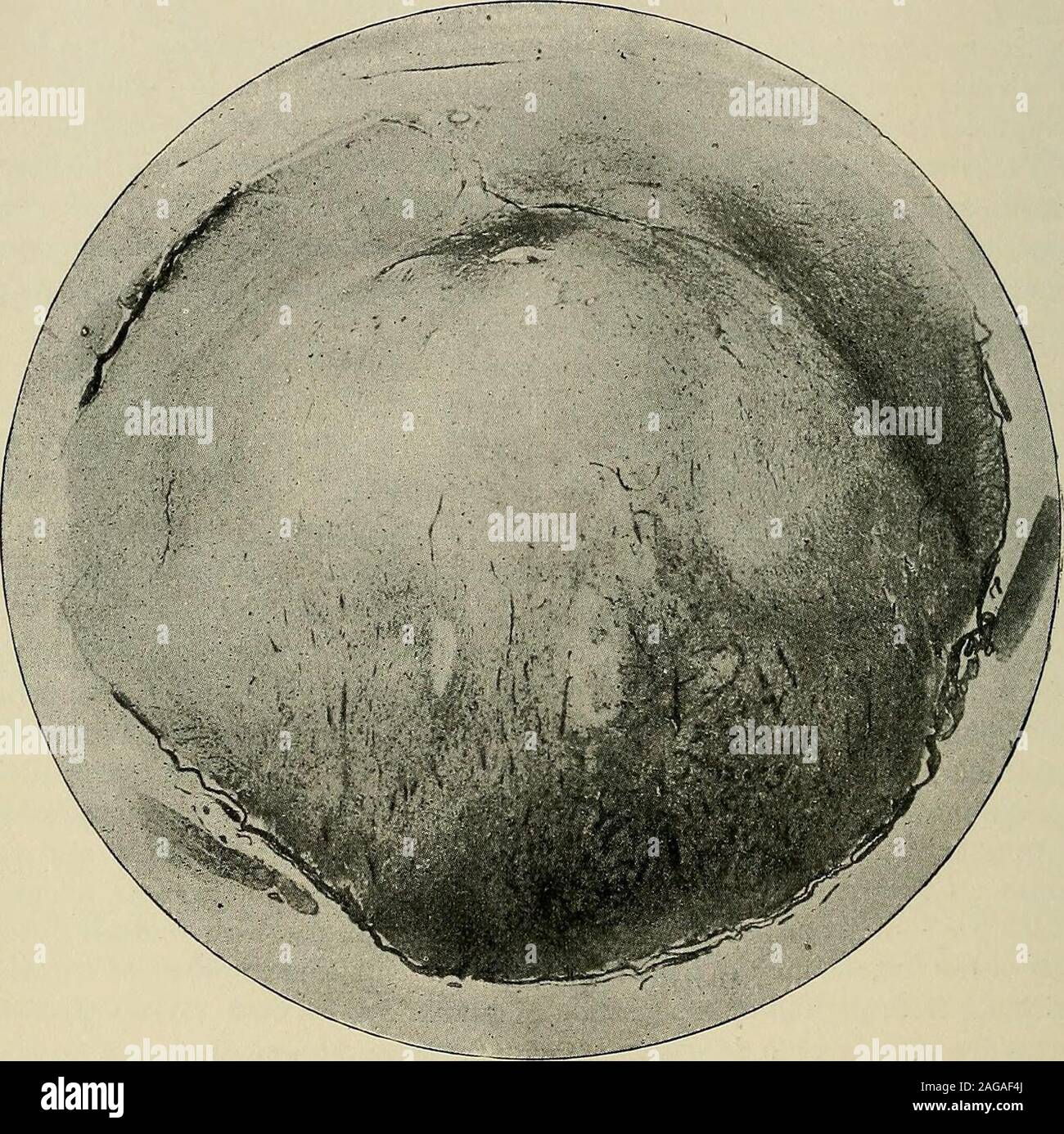 Skin atrophy hi-res stock photography and images - Alamy