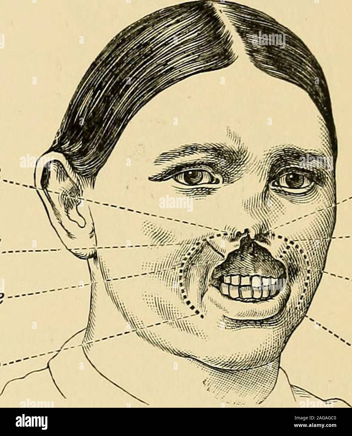 . Operative surgery. his deformity may be repaired by semi-circular ...