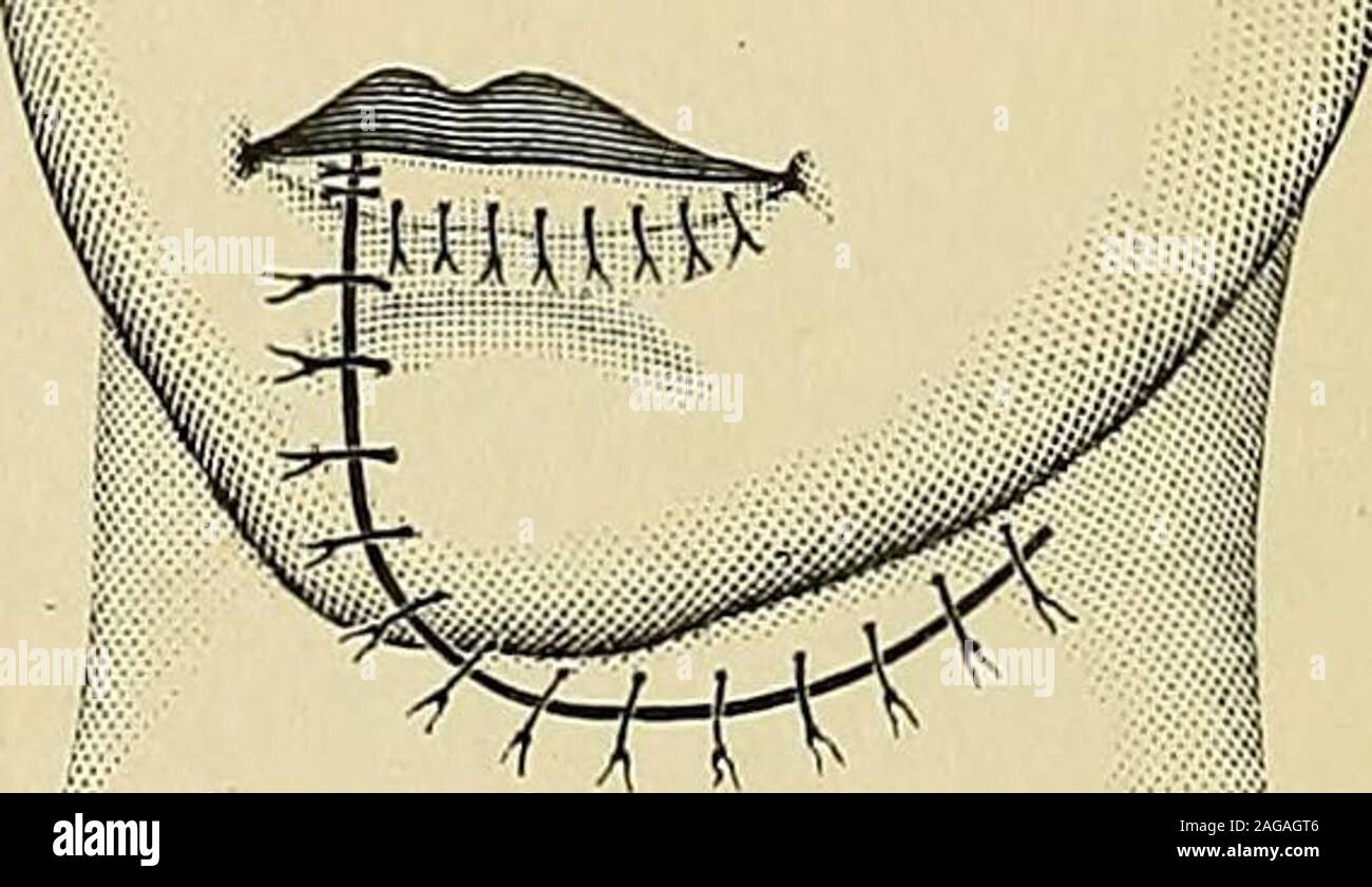 . Operative surgery. Fig. 780 «.—Brunss method.Vermilion border plan ...