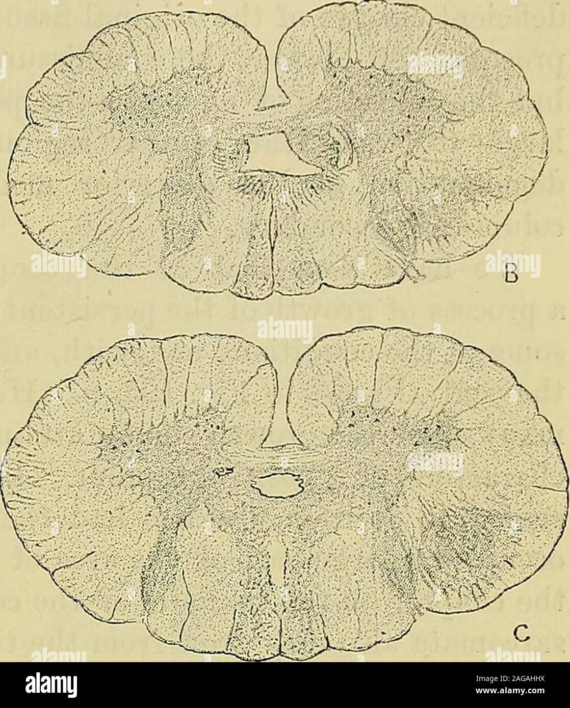 . A manual of diseases of the nervous system. ^ Fig-. 175.—Syringo ...
