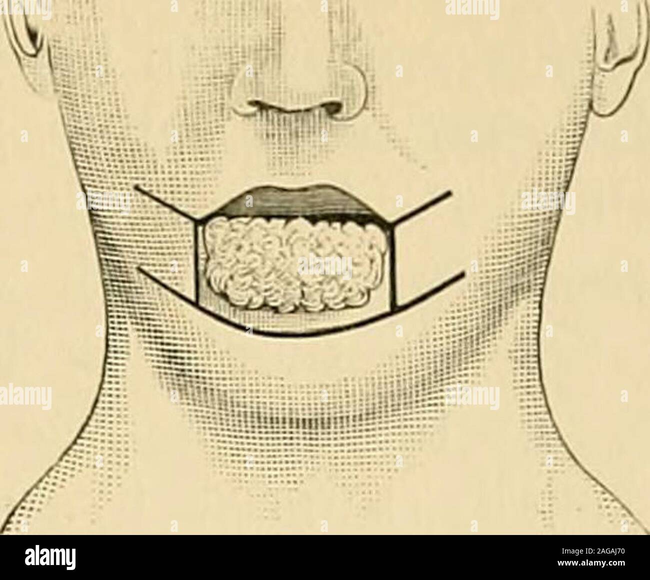 . Operative surgery. Fig. 776.—Bucks incision. PLASTIC SURGERY. fill ...