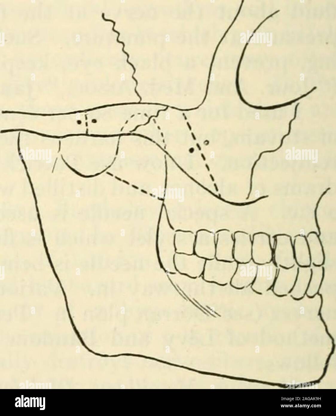 Pterygoid process hi-res stock photography and images - Alamy