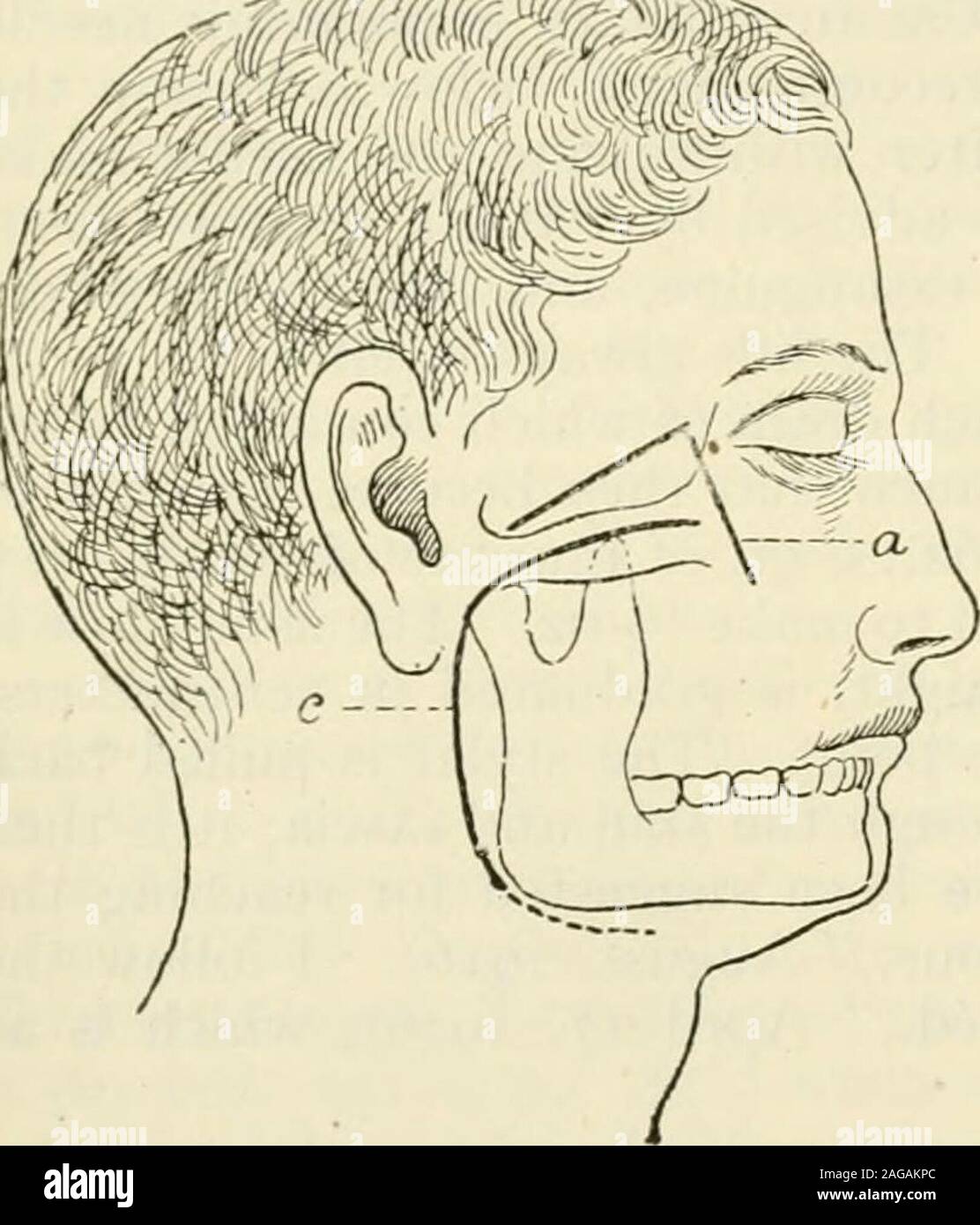 Subcutaneousfat hi-res stock photography and images - Alamy