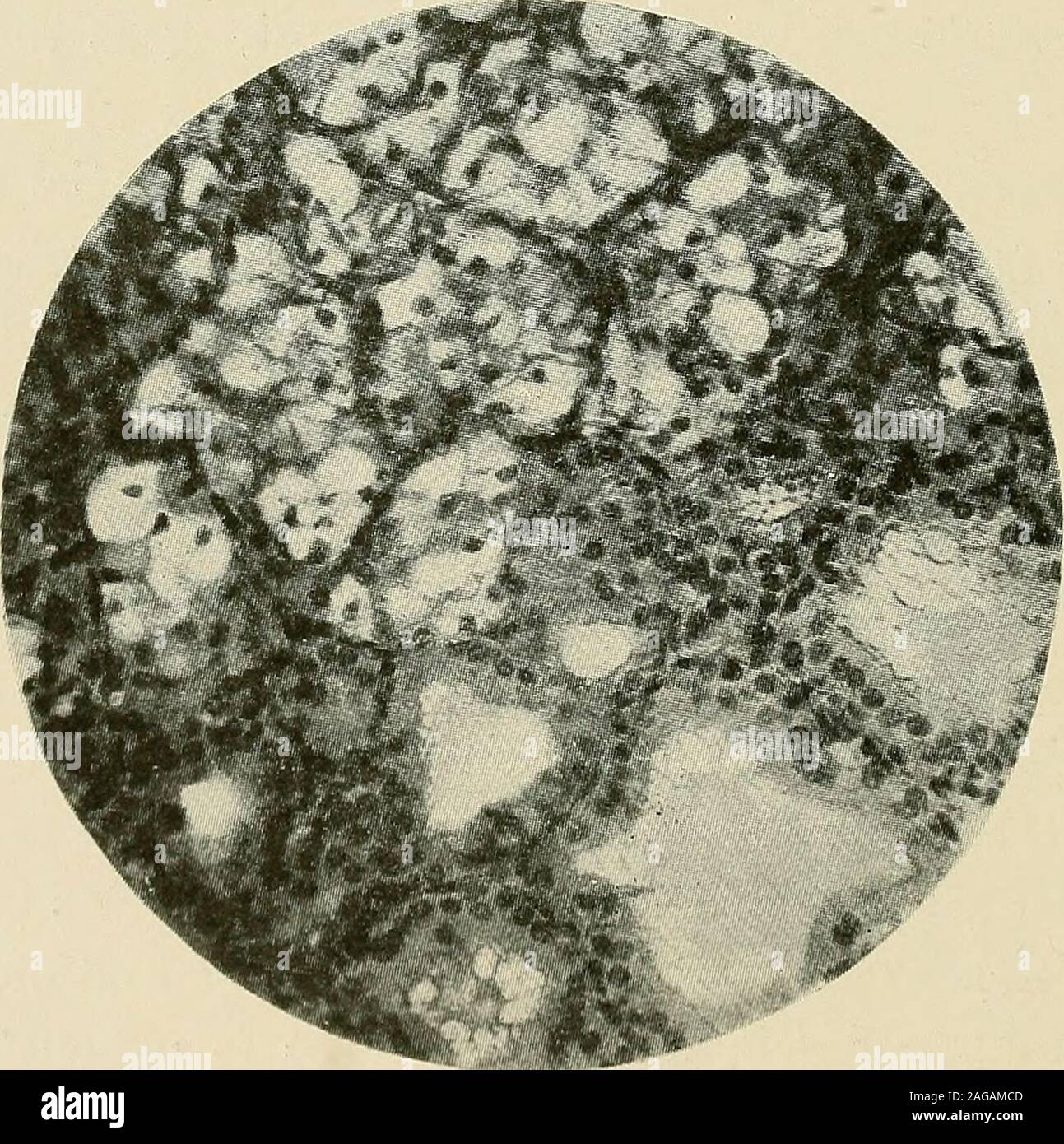 . The thyroid gland in health and disease. Fig. 21.—Section of thyroid ...
