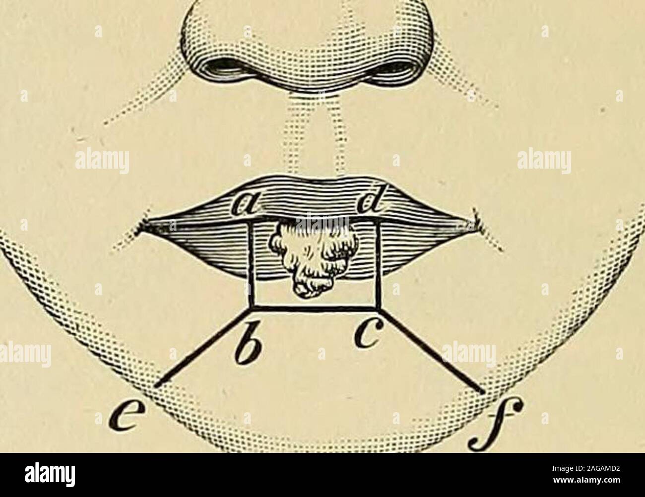. Operative surgery. Fig. 763.—Grants operation. Flap formed. Fig. 762 ...