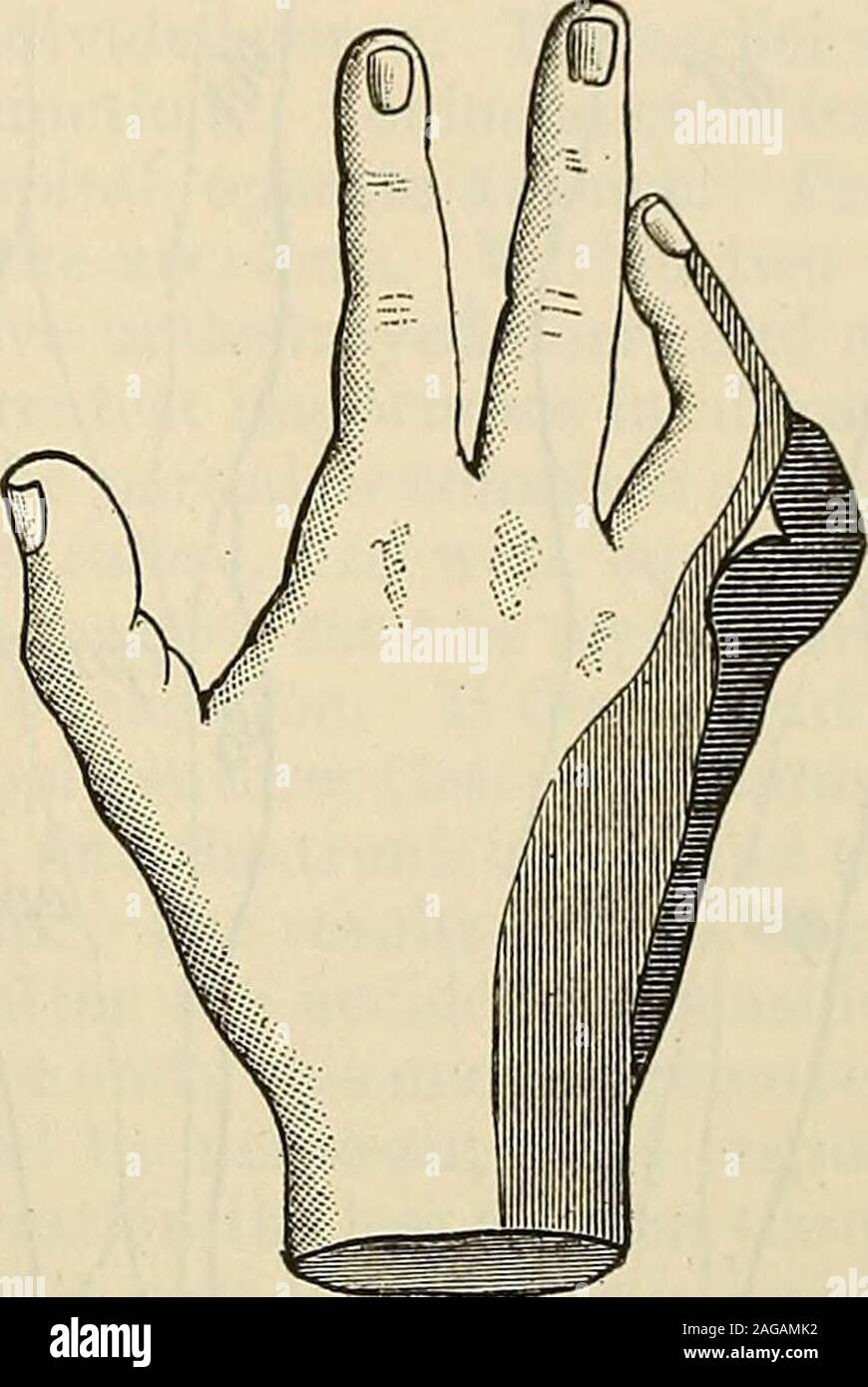 Ulnar nerve surgery hi-res stock photography and images - Alamy