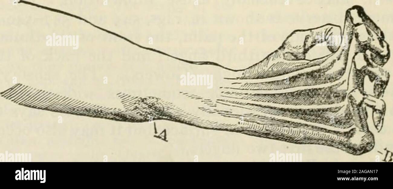 Ulnar nerve surgery hi-res stock photography and images - Alamy