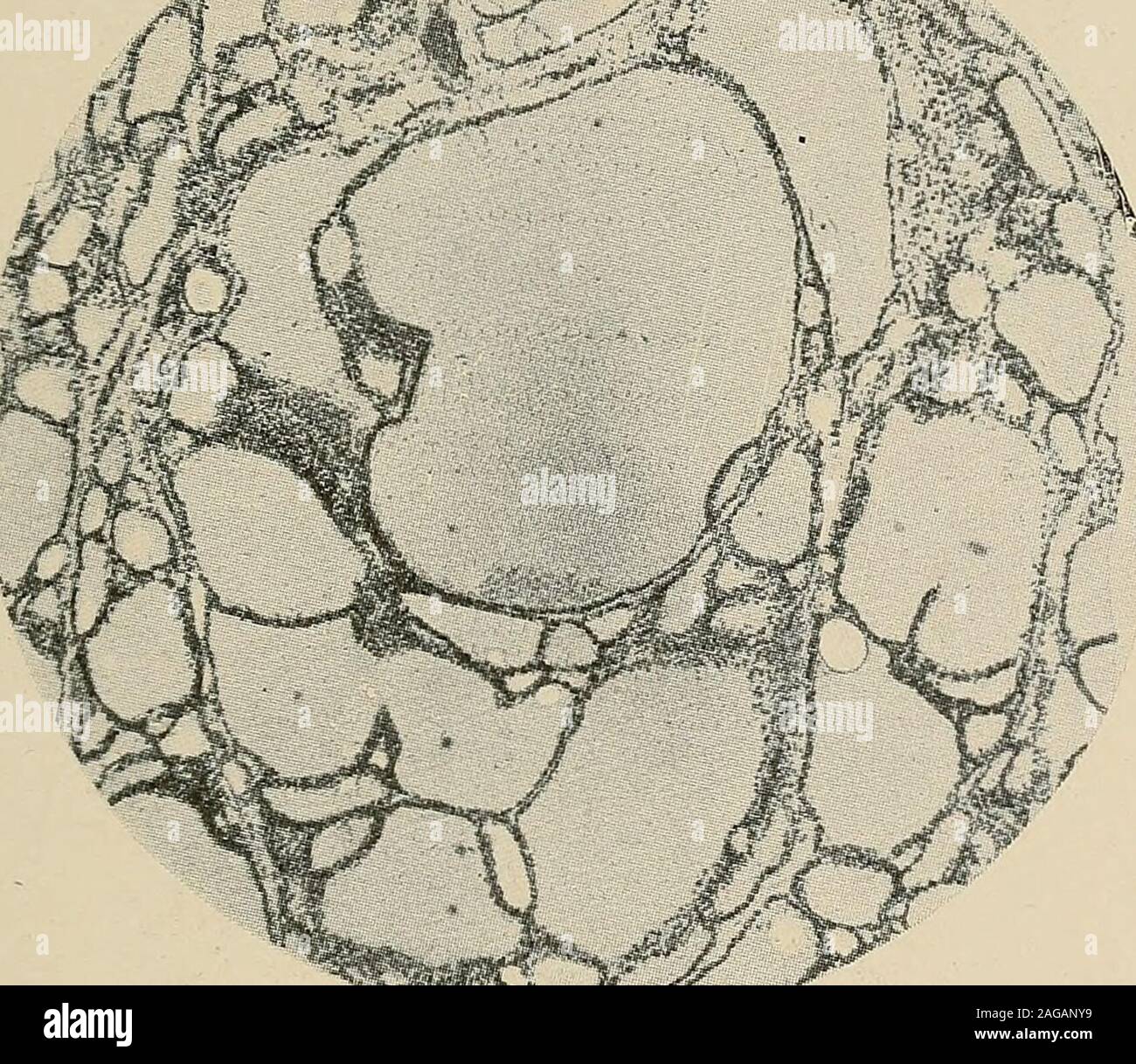 Colloid in thyroid hi-res stock photography and images - Alamy