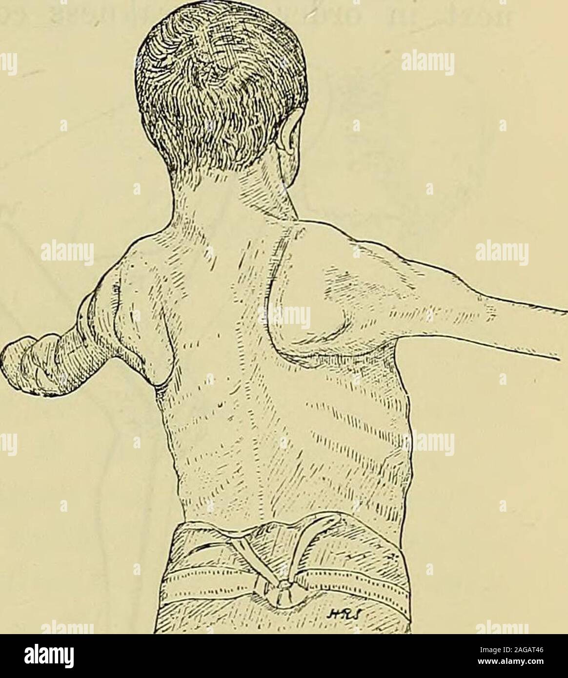 . A manual of diseases of the nervous system. Fig-. 148.— Pseudo ...