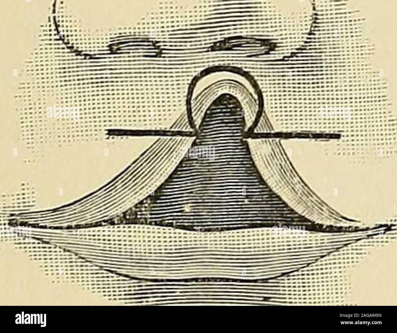 . Operative surgery. Method (Mirault) (Fig. 748).—Draw down both ...