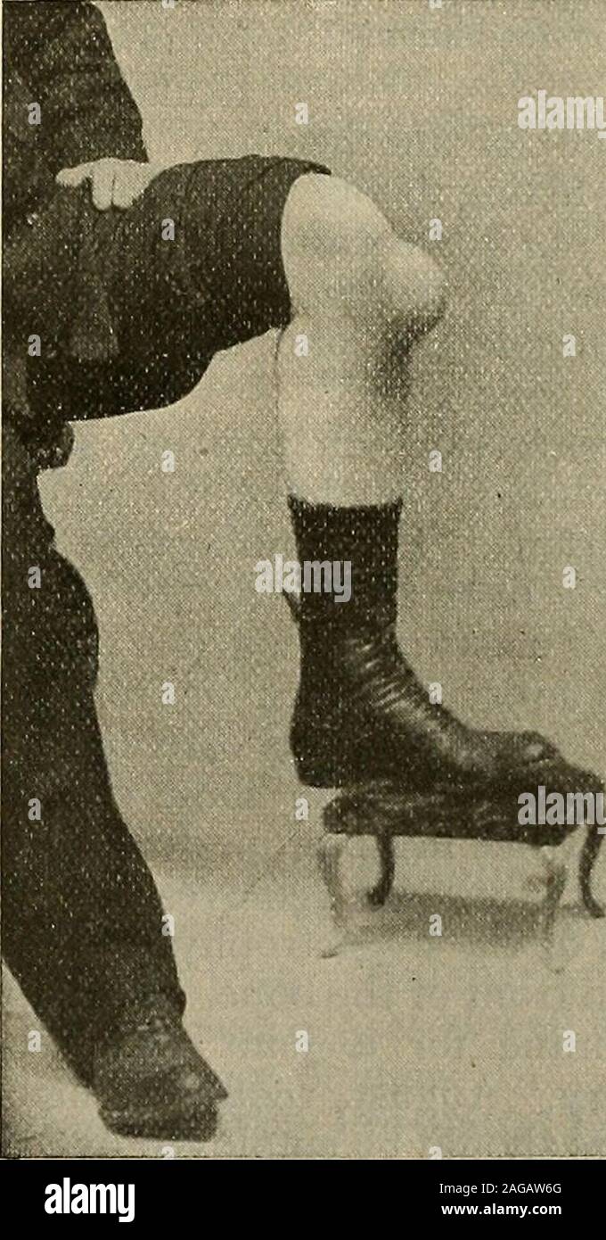 . Modern surgery, general and operative. Fig. 523.—Bursitis of left ...