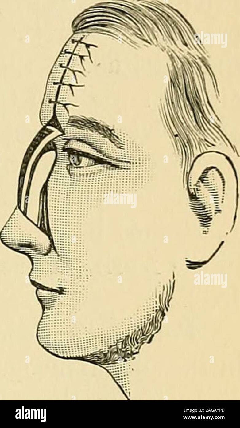 . Operative surgery. Fig. 739.—Olliers method. Pig. 740.—Konigs method ...