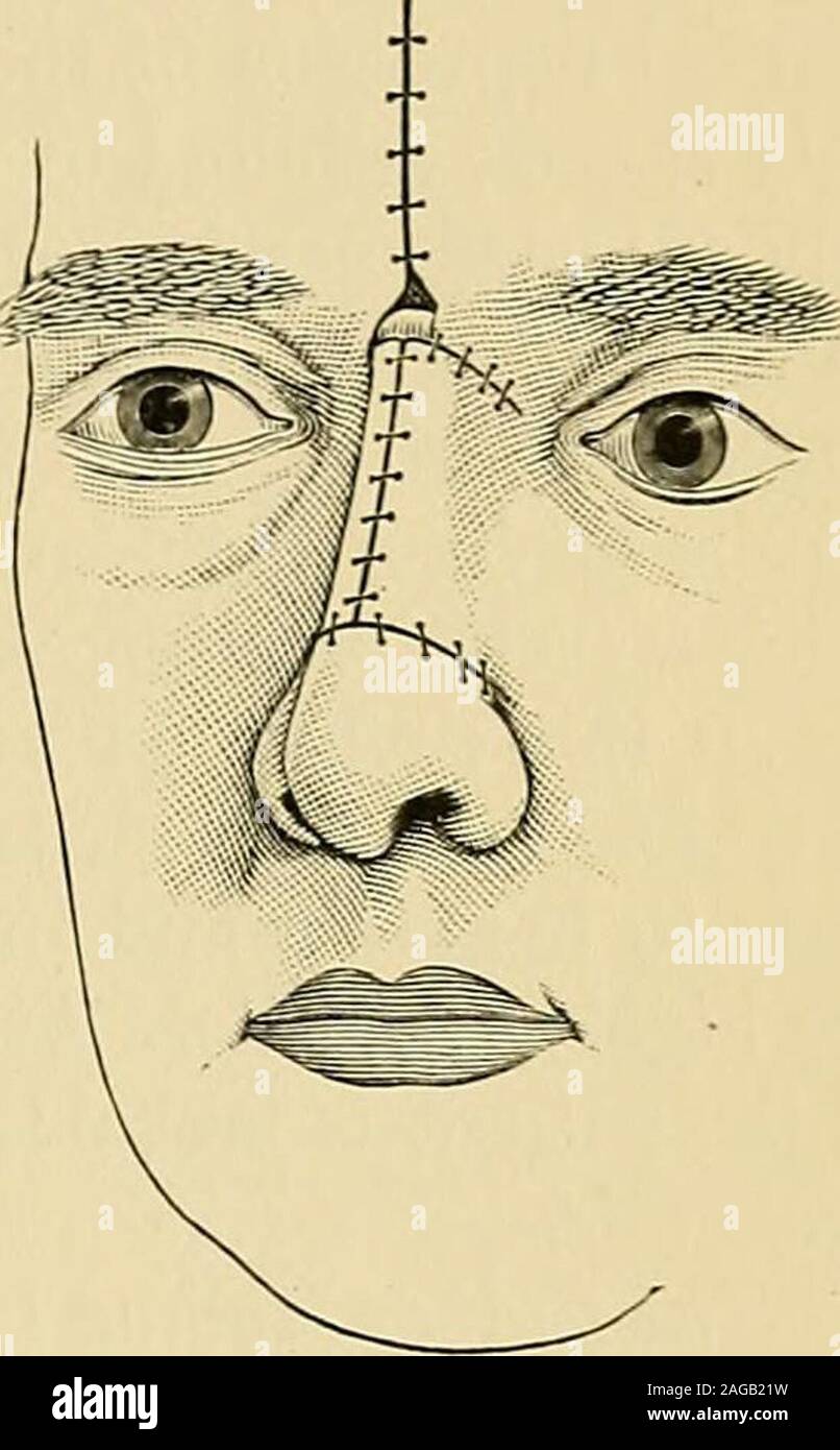 . Operative surgery. a c d Fig. 730.—Verneuils method of operation.a ...