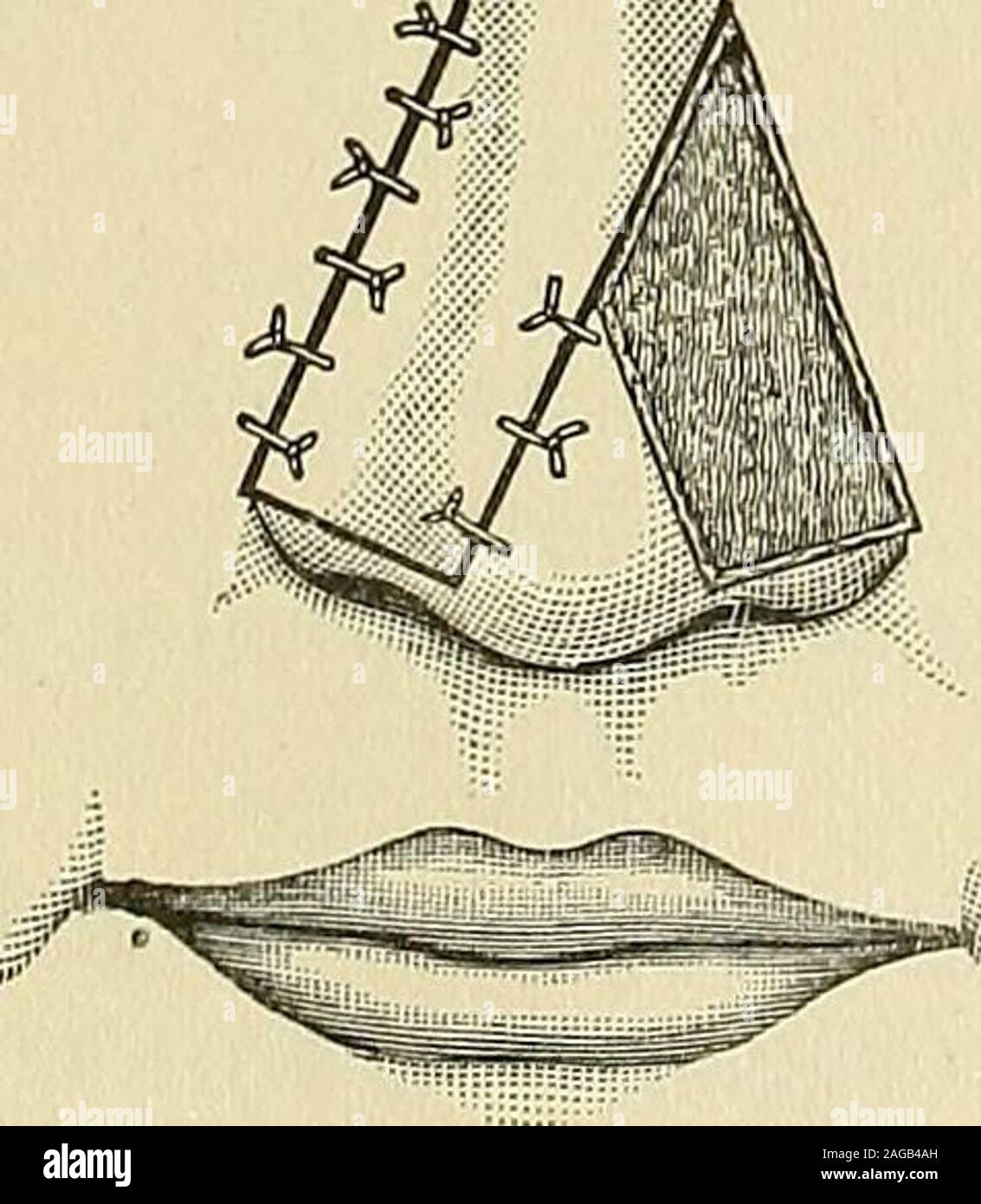 . Operative surgery. FiG. 733.—Elliss method, from lipand cheek Stock ...