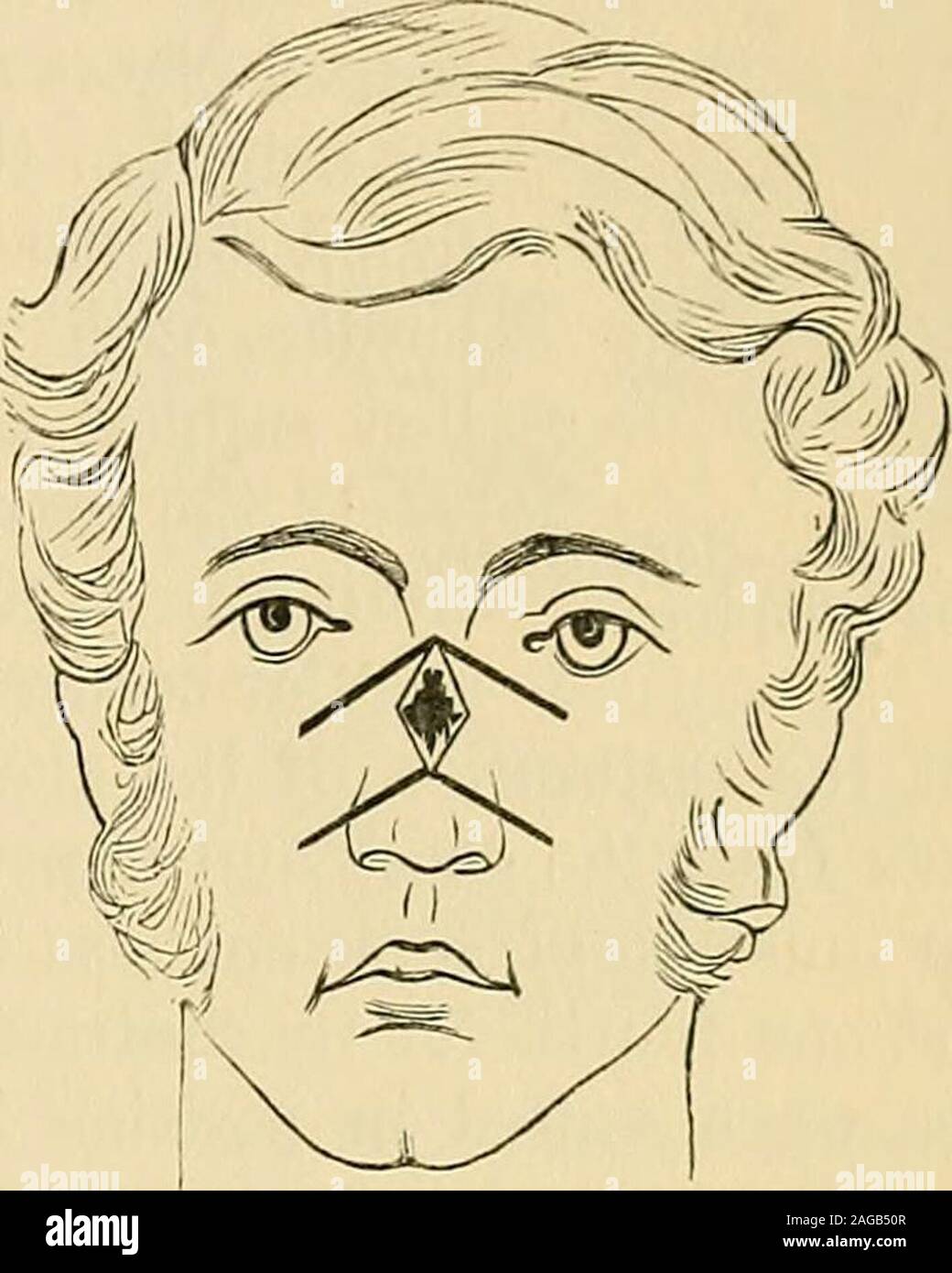 . Operative surgery. psin the cheeks were closed with suturesand ...