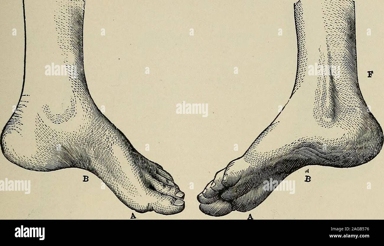 . A treatise on the nervous diseases of children : for physicians and ...