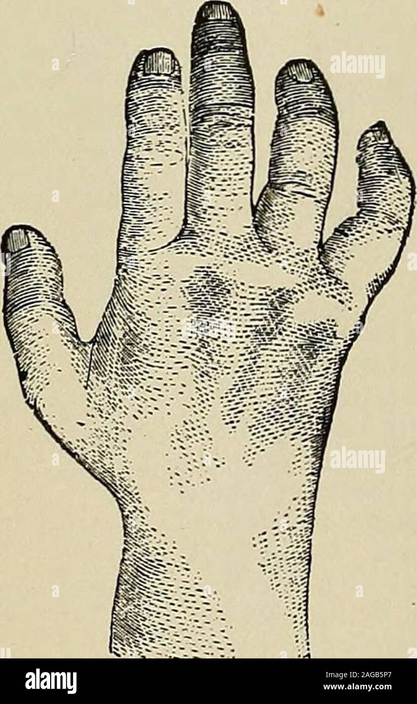 . A treatise on the nervous diseases of children : for physicians and ...