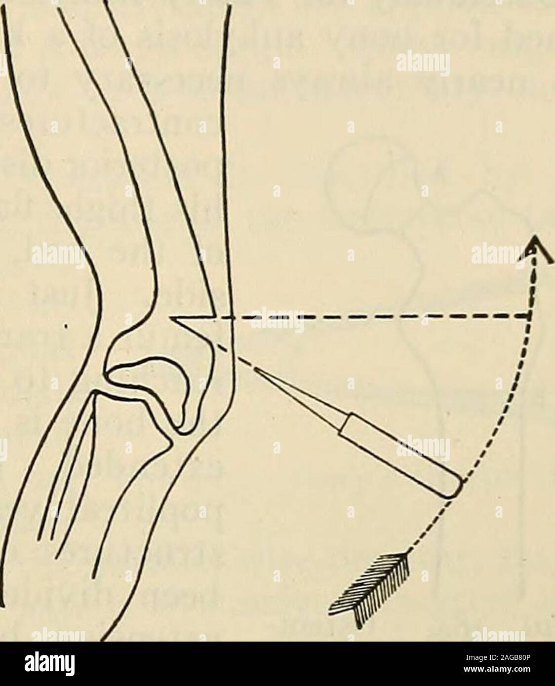 Osteotomy of femur hi-res stock photography and images - Alamy