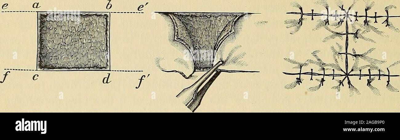 . Operative surgery. he defect, parallelincision, h. Closure, slidingin ...