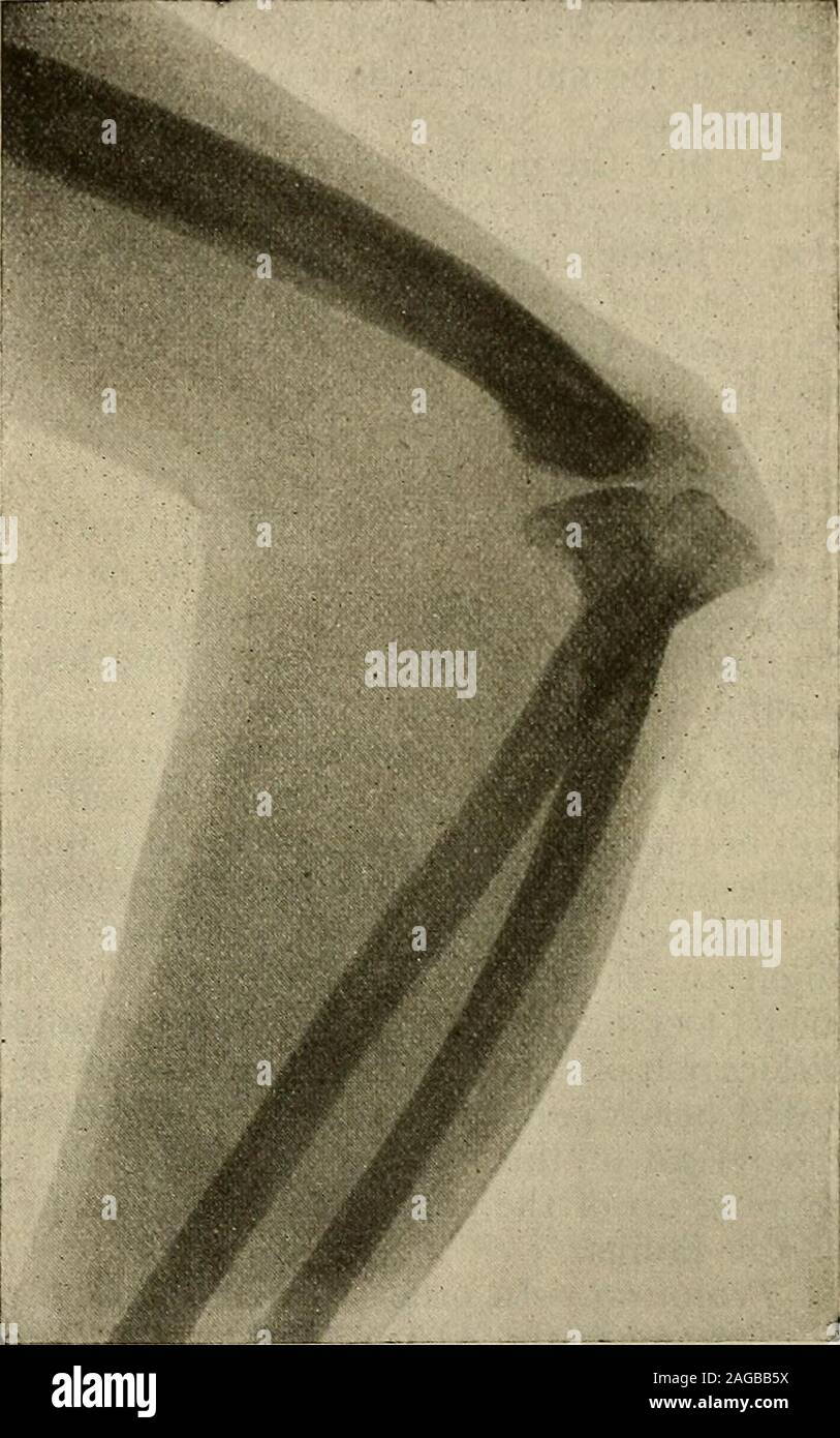 Flexion and extension arm hi-res stock photography and images - Alamy