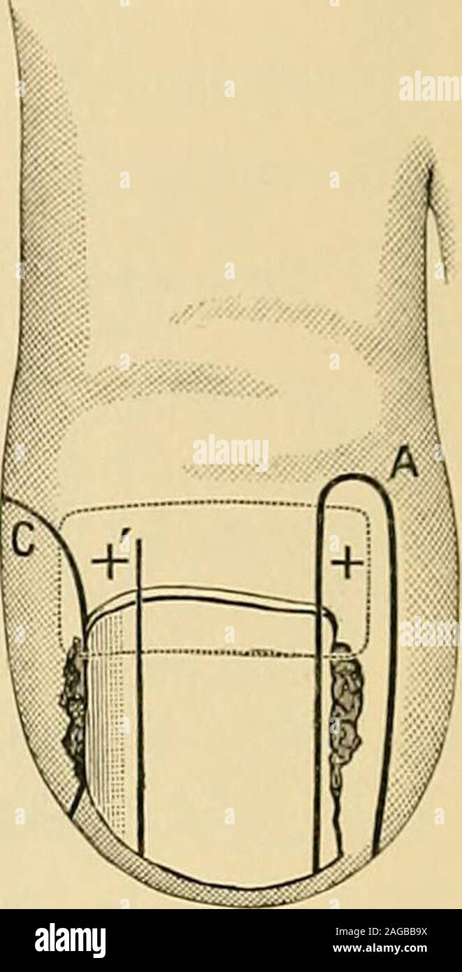 . Operative surgery. Fig. 686.—Fowlers operation. Formationof flaps and ...
