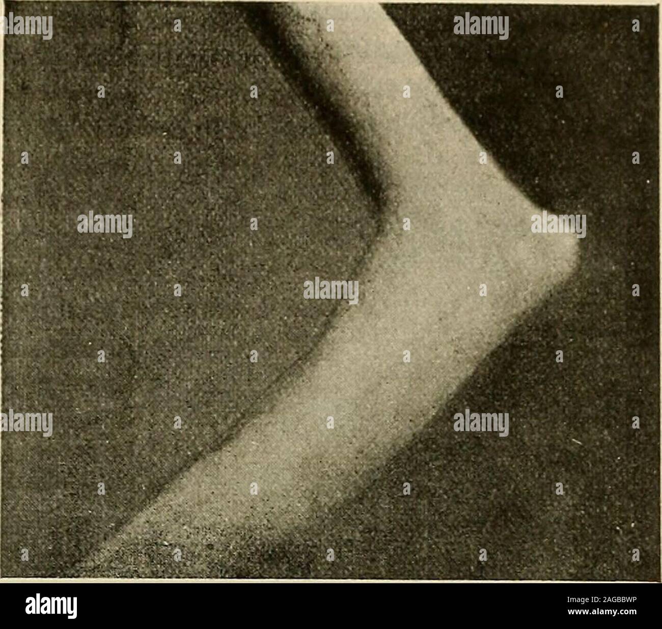 Habitual shoulder dislocation hi-res stock photography and images - Alamy