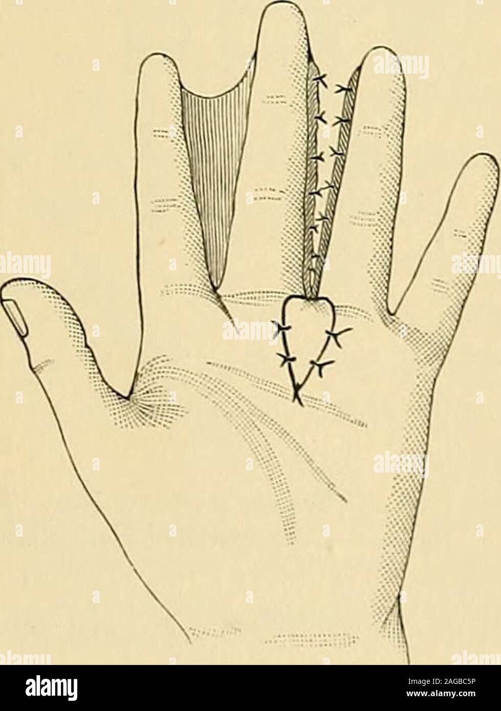 Posterior flap hi-res stock photography and images - Alamy