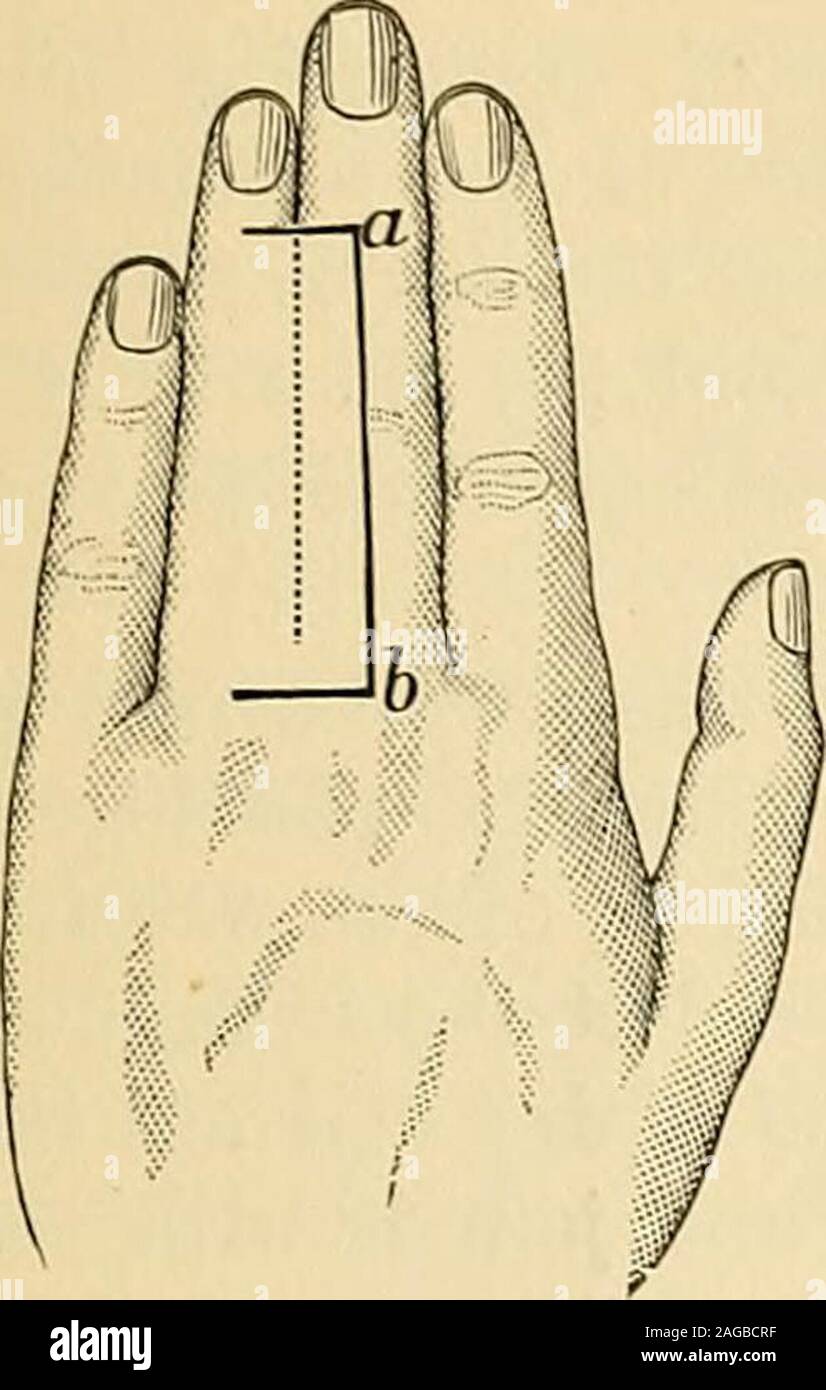 Palmar incision hi-res stock photography and images - Alamy