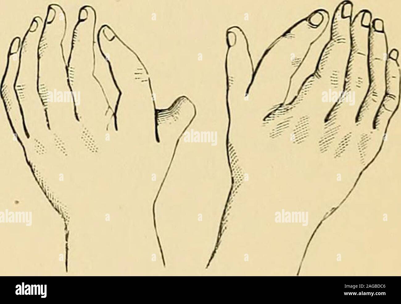 . Operative surgery. Fig. 679.—3IallL4-finffer. Fig. 680.—Supernumerary ...