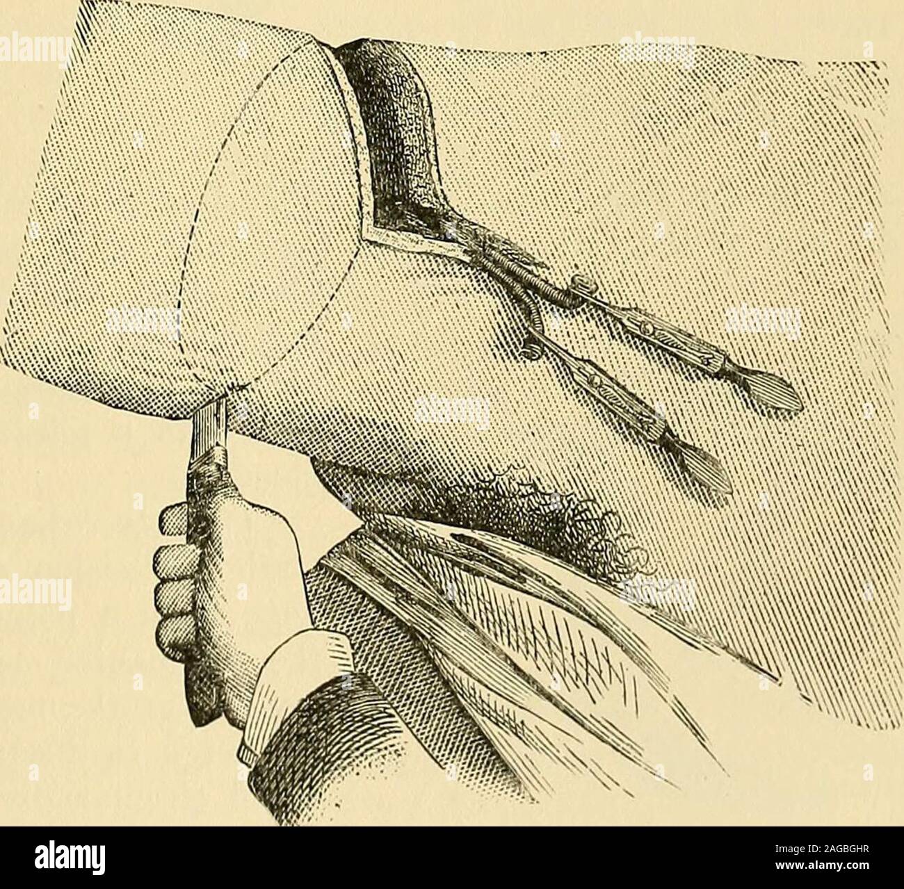 . Operative surgery. Fig. 664.—Elastic ligature. strong forceps ...