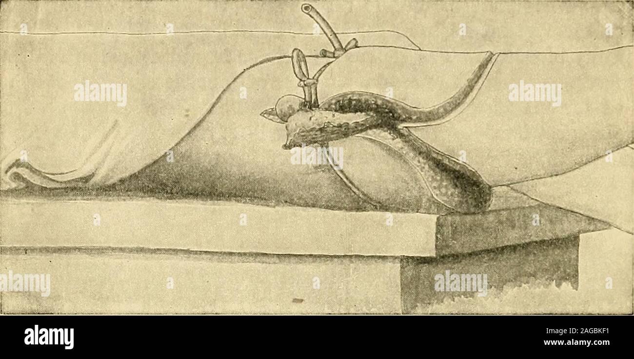 . Operative surgery. ead of femur dislocatedthrough incision. Elastic ...