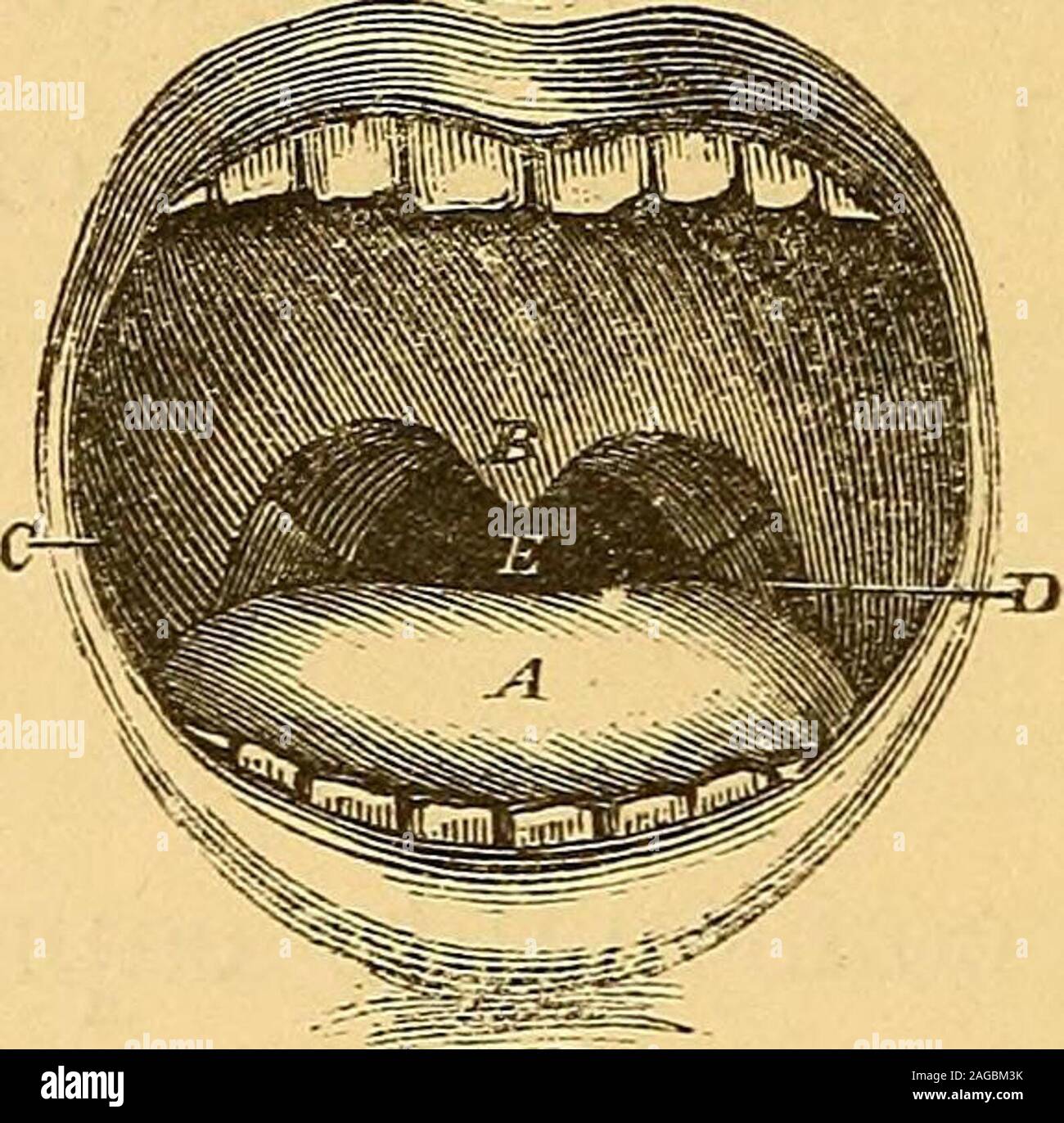 . On articulate sounds : and on the causes and cure of impediments of ...