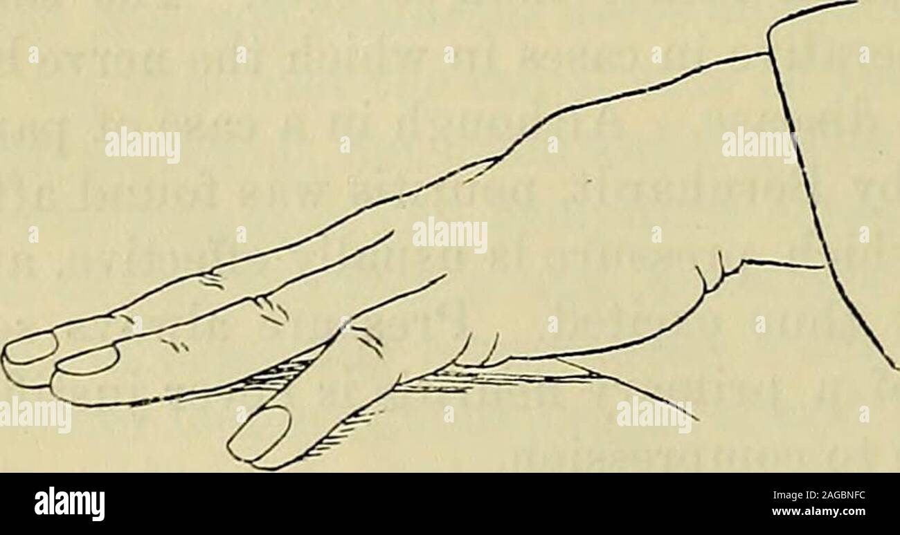 Músculo extensor hi-res stock photography and images - Alamy