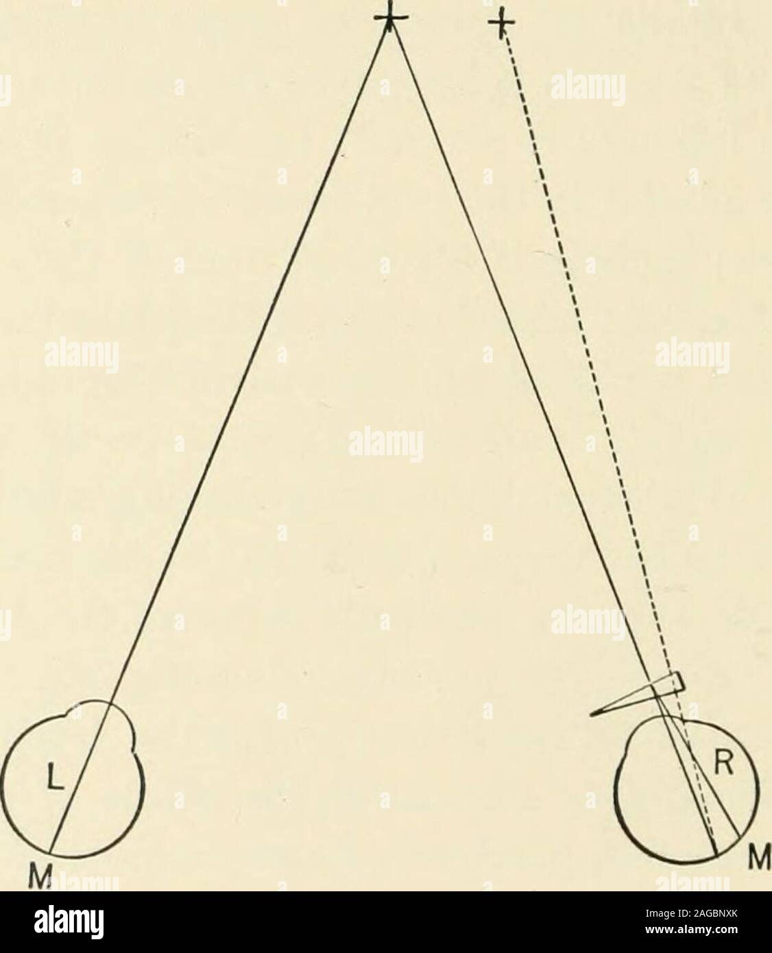 Diplopia hi-res stock photography and images - Alamy