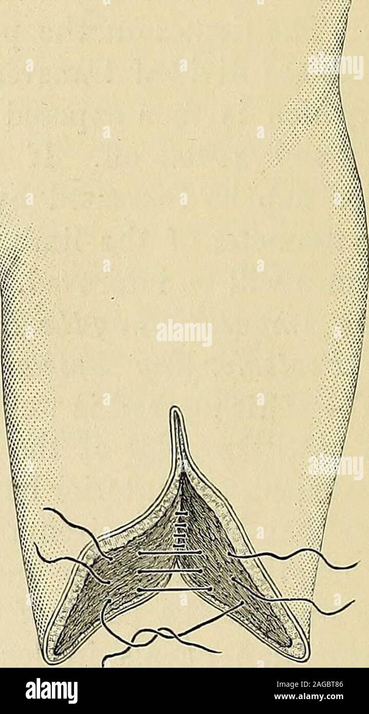 . Operative surgery. Fig. 641.—Amputation of thigh. Perios-teum sewed ...