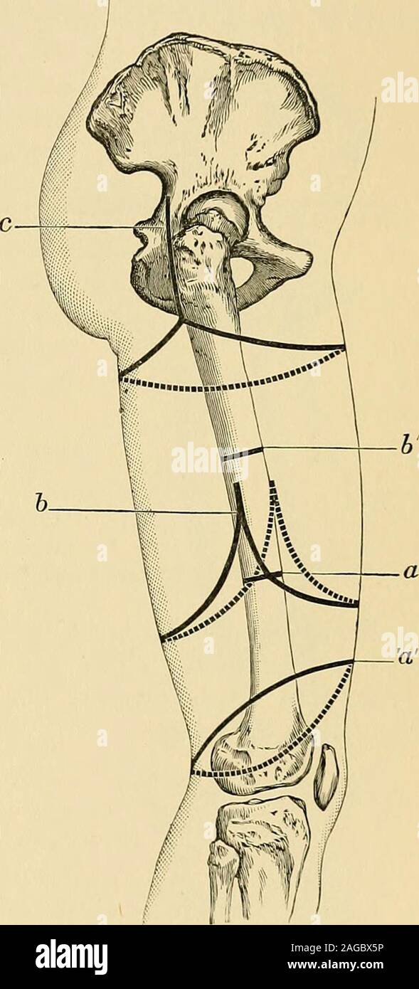 Circular amputation hi-res stock photography and images - Alamy