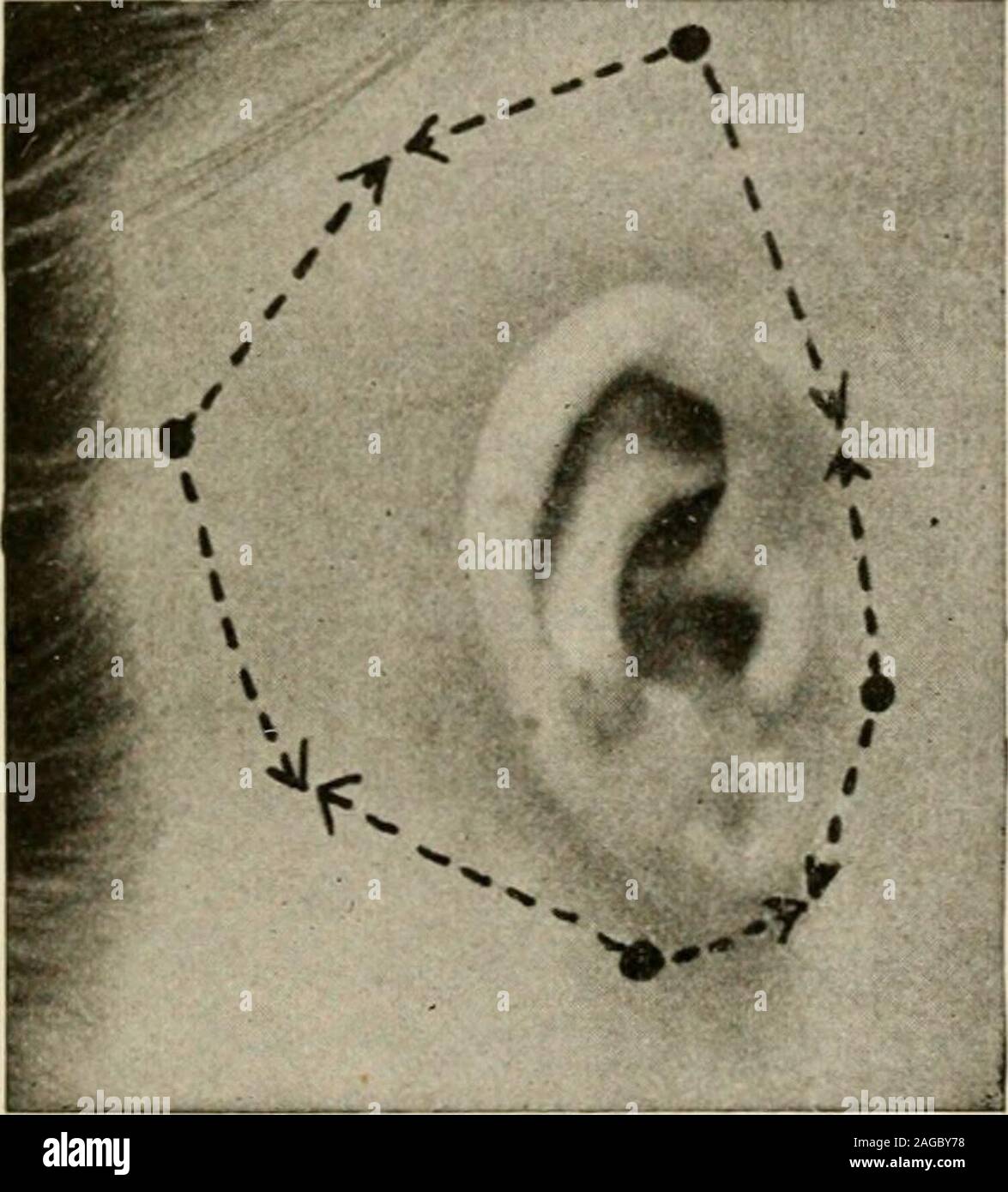 Spinal infiltration hi-res stock photography and images - Alamy