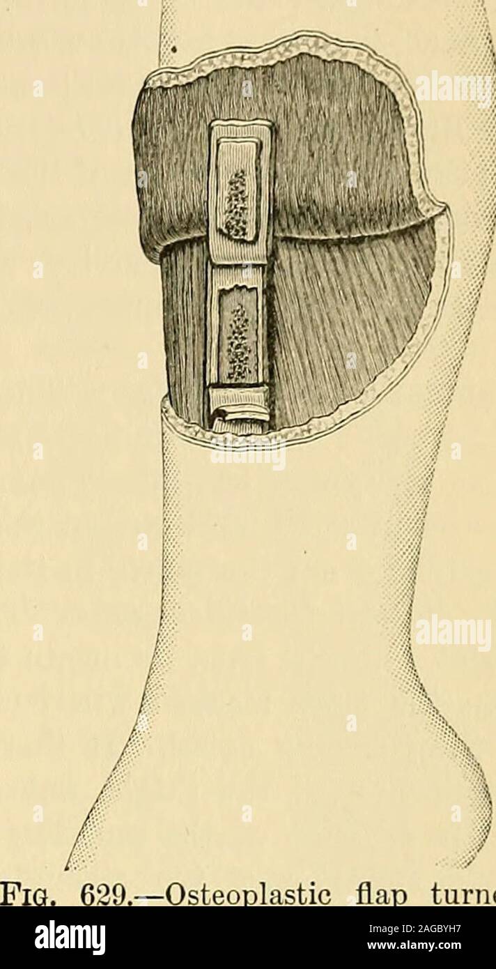 . Operative surgery. Fig. 638.—Osteoplastic flap. Method ofBier and ...