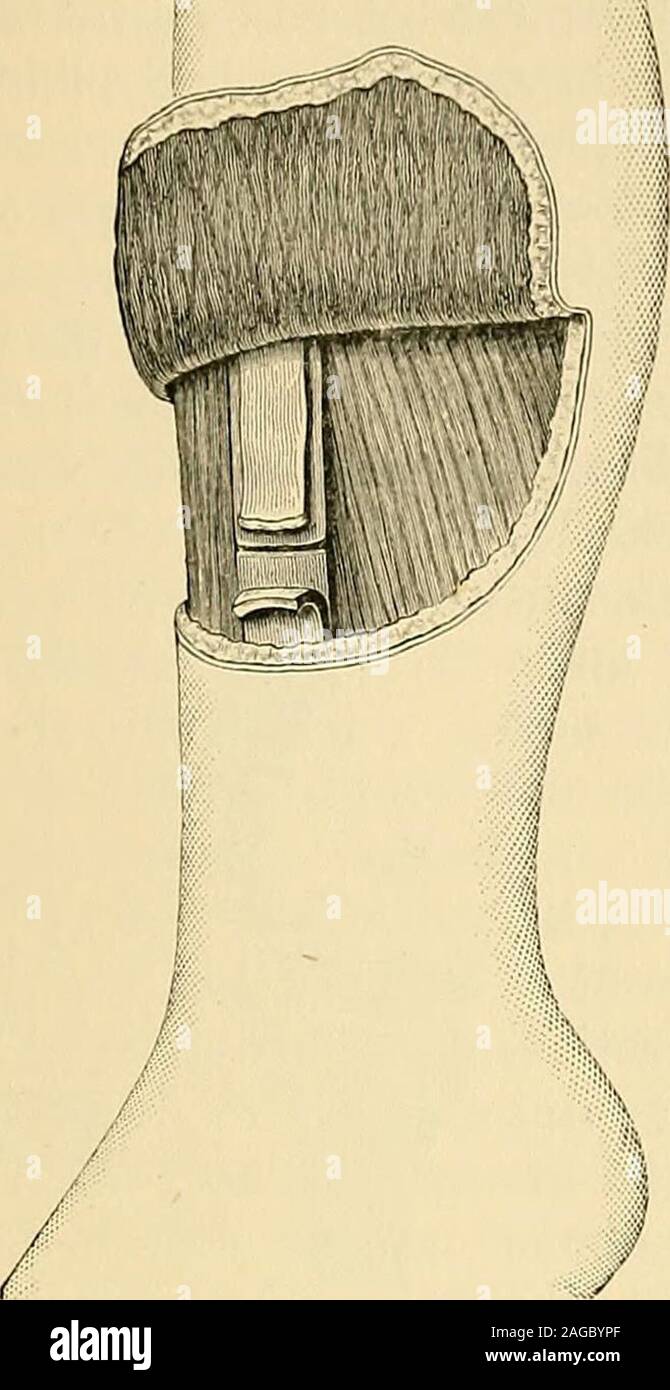 Leg amputation stump hi-res stock photography and images - Alamy