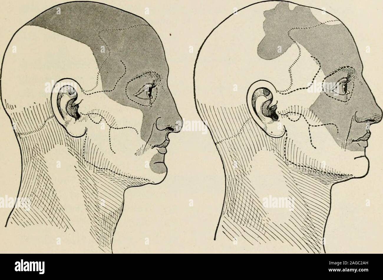 Trephining skull hi-res stock photography and images - Alamy