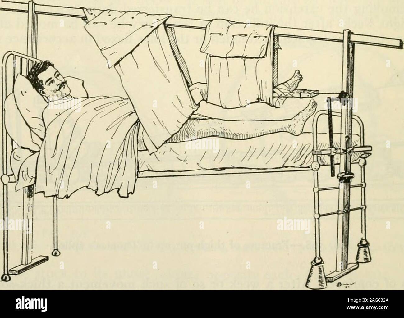 Jones fracture hi-res stock photography and images - Alamy